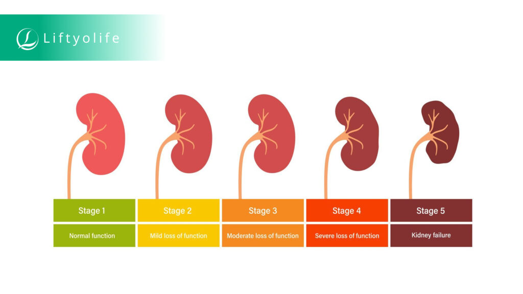 Stage 3 Kidney Disease: Symptoms & Treatment | Liftyolife